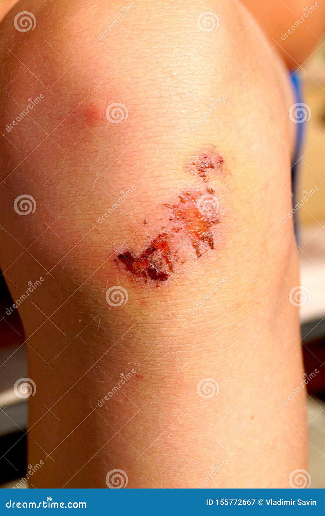 Dried Blood on the Scratch on the Knee after Falling Stock Image ...
