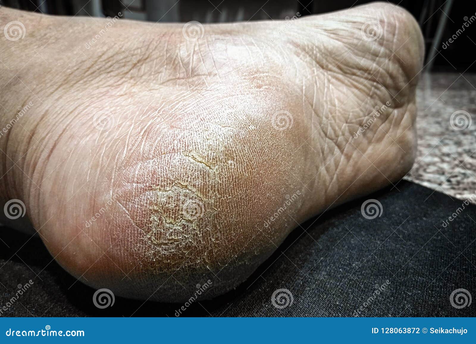 Dried and Cracked Skin on the Heal. Stock Photo - Image of heel, care ...