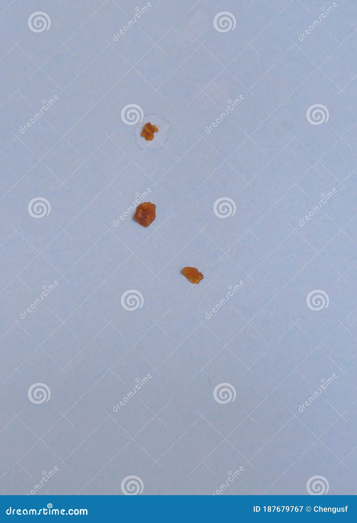 Dried Tonsil Stone Tonsillolith Stock Image - Image of educational ...