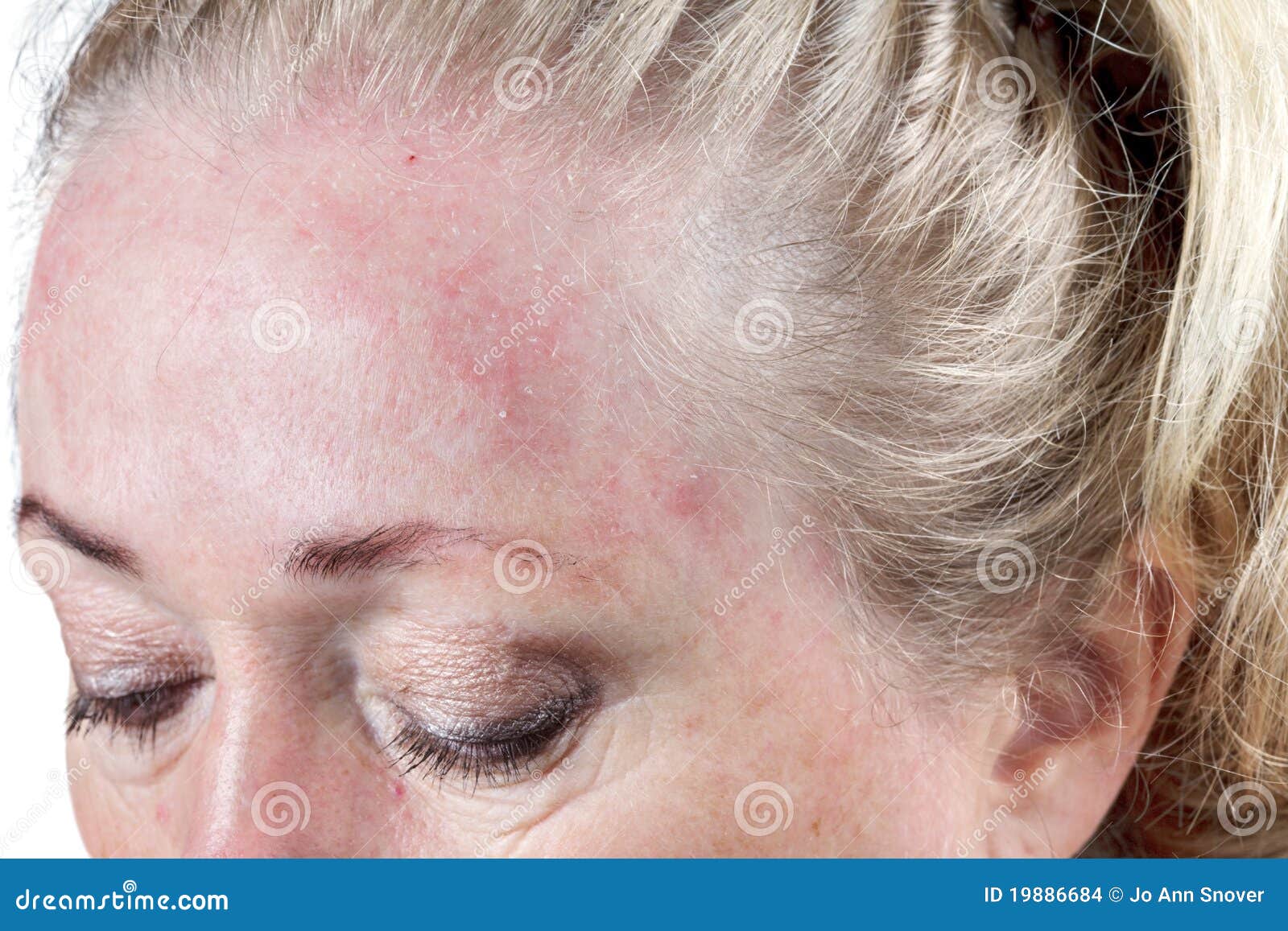 Droge huid stock foto. Afbeelding bestaande uit achtergrond - 19886684