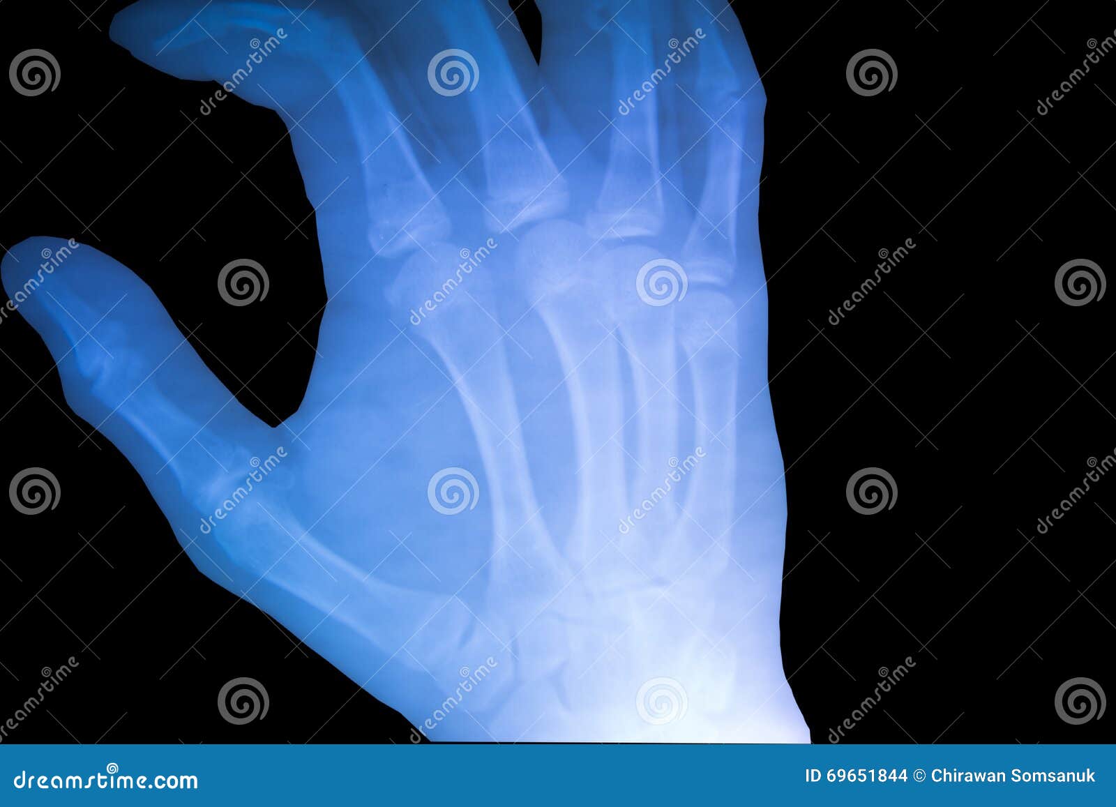 Droite De La Main De L'humain Normal De Projection De Rayon X Photo ...