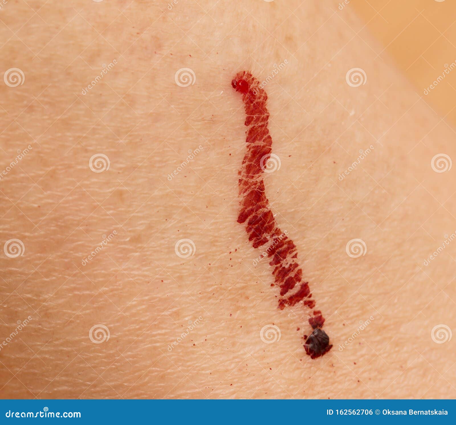 A Drop of Blood on the Skin Stock Photo - Image of sore, drop: 162562706
