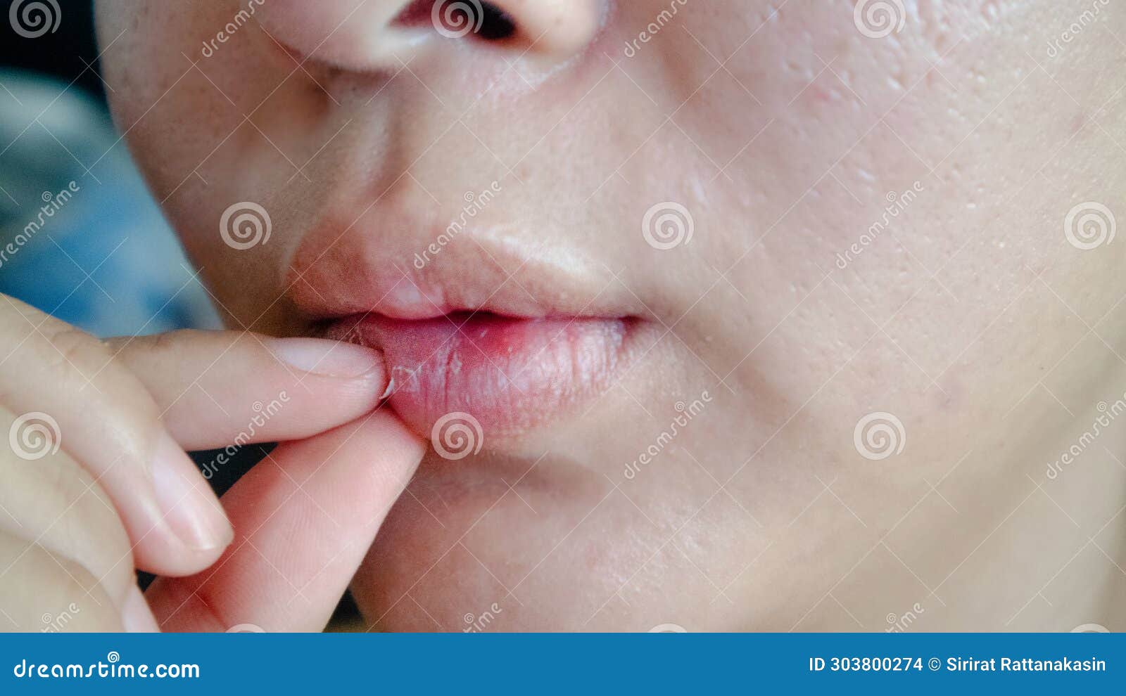 Dry, Chapped, Peeling Lips :dry Skin Problem with Mouth Stock Photo ...