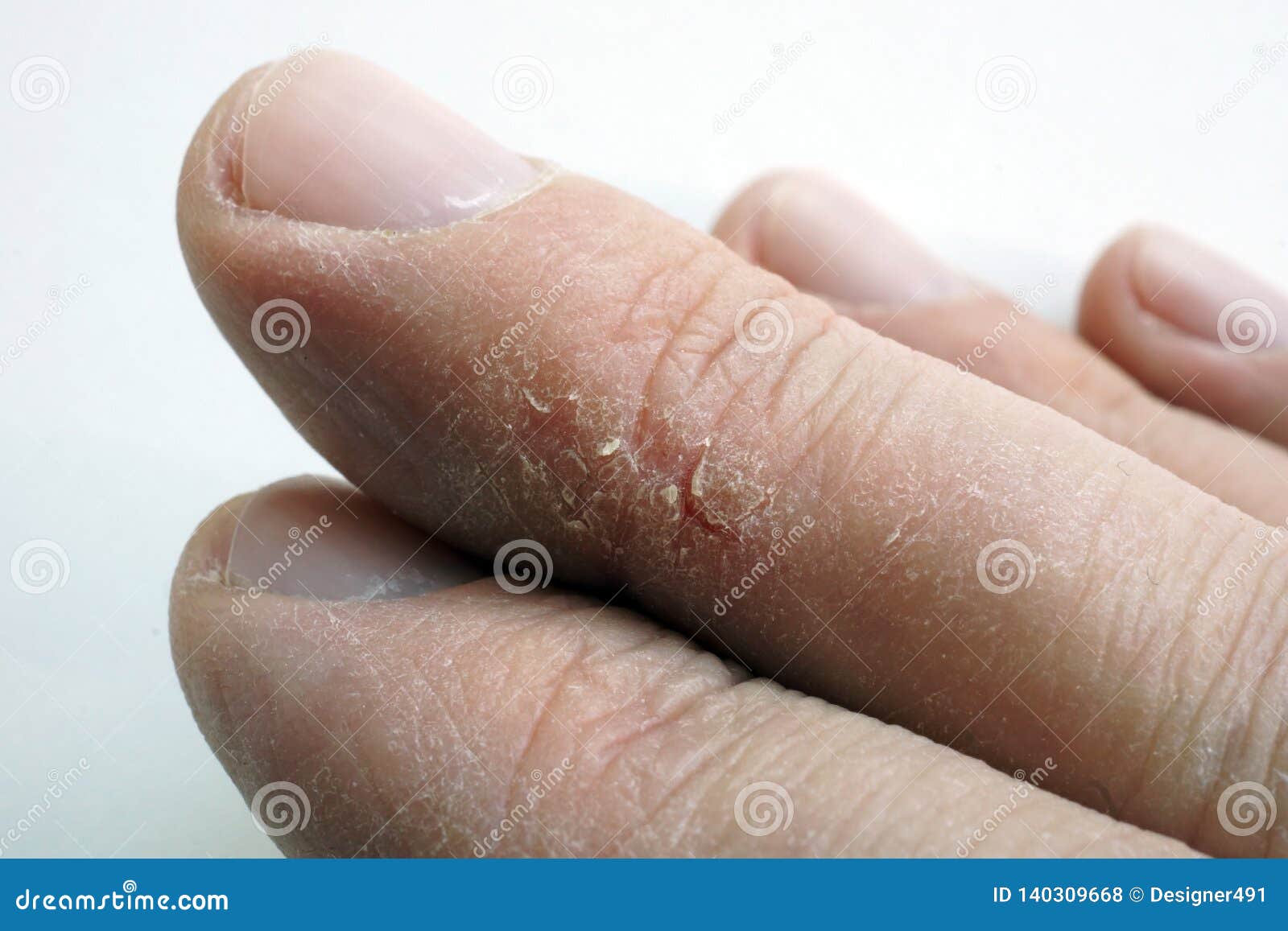 Dry Cracked Skin on Fingers. Fingers with Dermatology Problems Stock ...