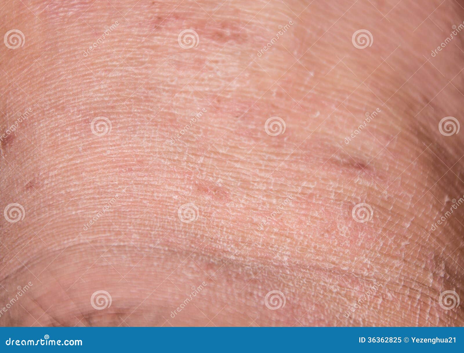Dry Cracking Skin in the Winter Stock Image - Image of crack ...