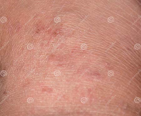 Dry Cracking Skin in the Winter Stock Photo - Image of feature, water ...