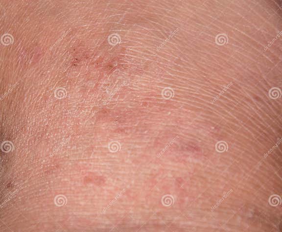 Dry Cracking Skin in the Winter Stock Photo - Image of feature, water ...