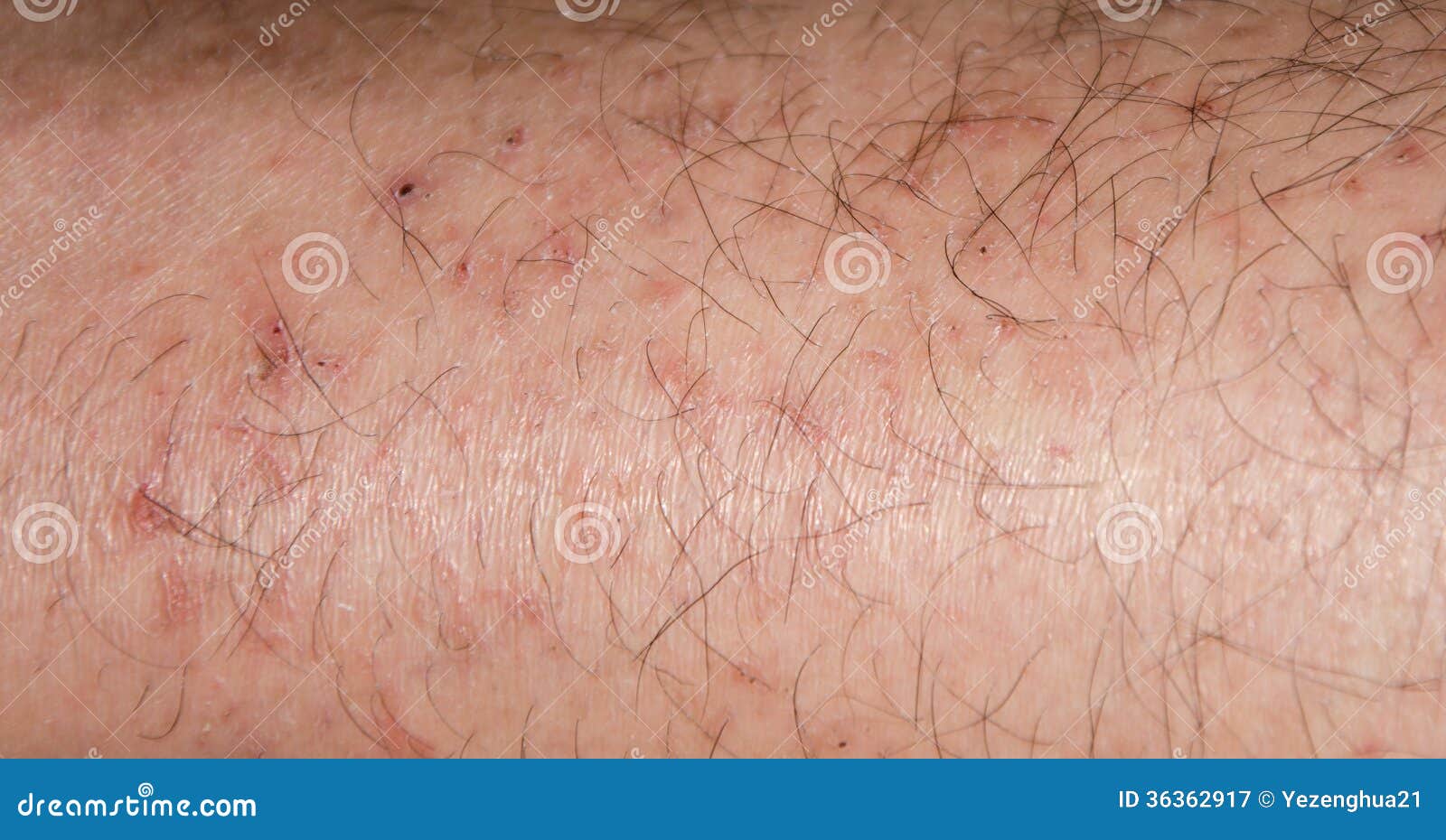 Dry Cracking Skin in the Winter Stock Image - Image of closeup ...