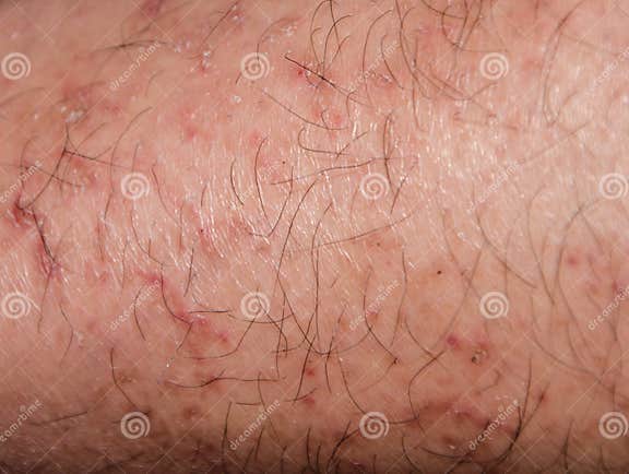 Dry Cracking Skin in the Winter Stock Photo - Image of closeup ...