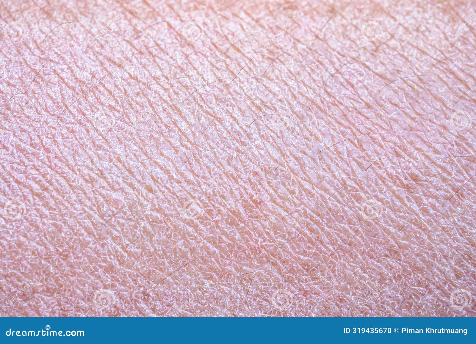 Dry and Dehydrated Human Skin Texture Stock Photo - Image of xerosis ...