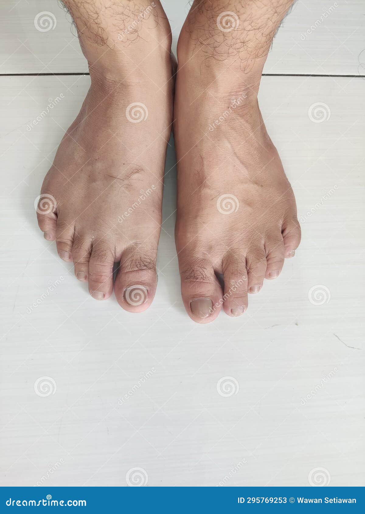 Dry Feet that are Poorly Cared for Stock Image - Image of hands ...