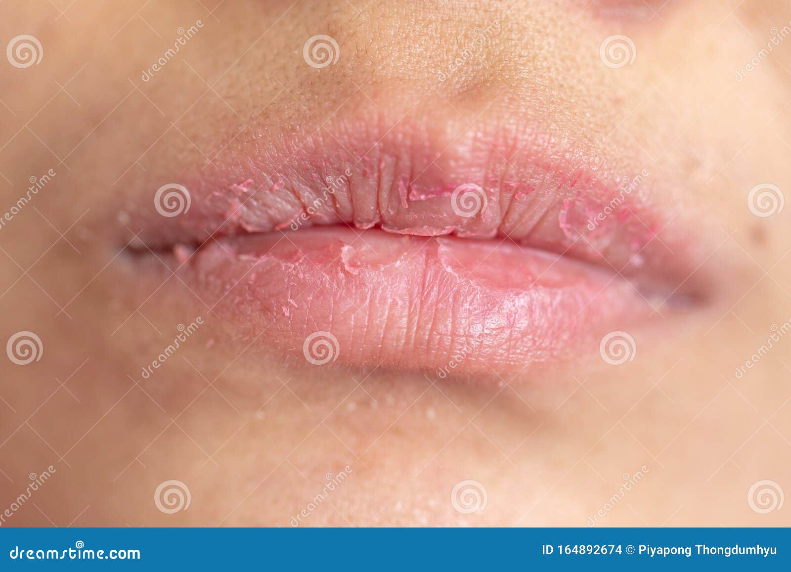 Dry lips in the clinic. stock photo. Image of cosmetic - 164892674