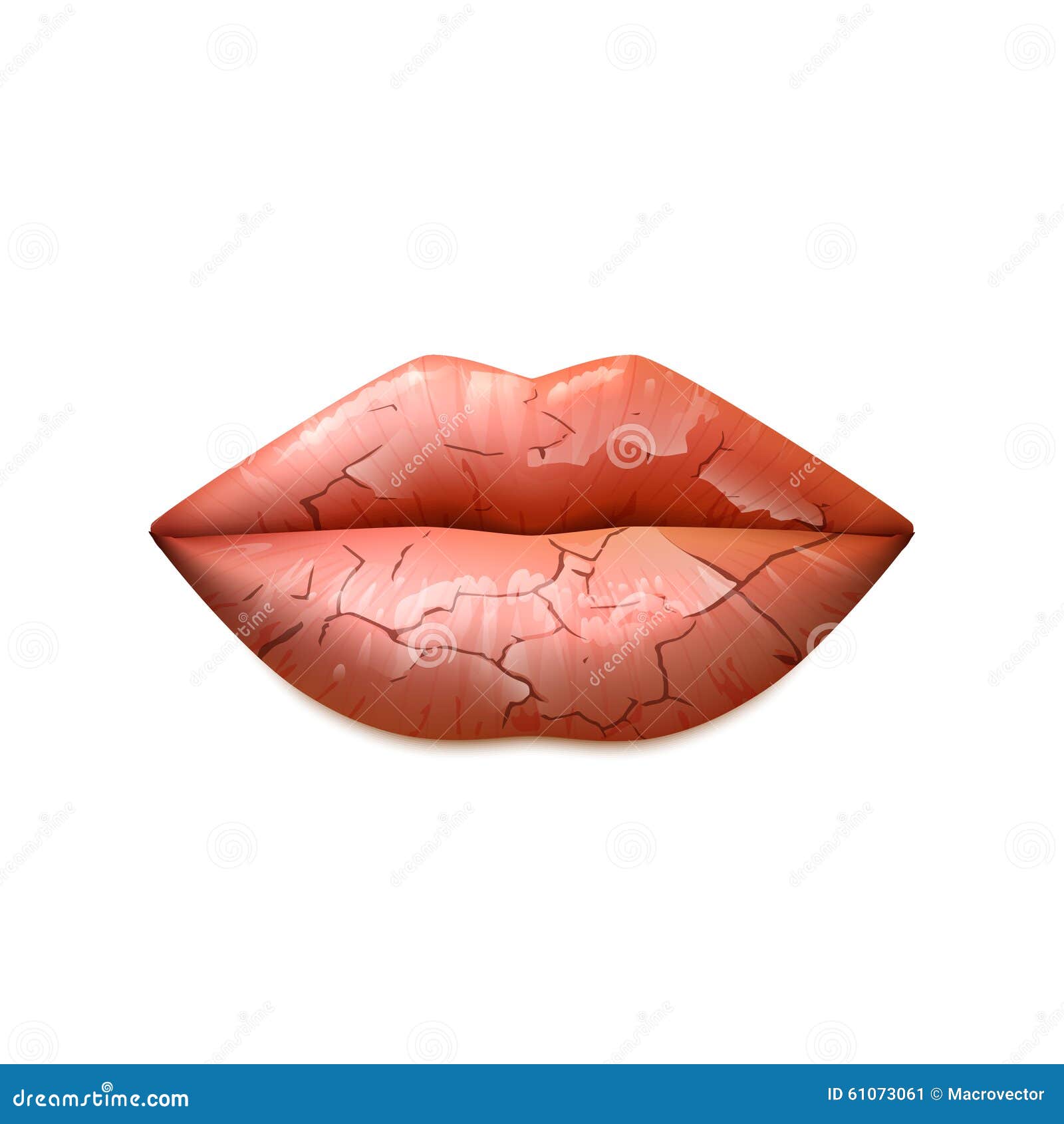 Cracked Lips / Dry Lips / Organ And Anatomy Cartoon Vector ...