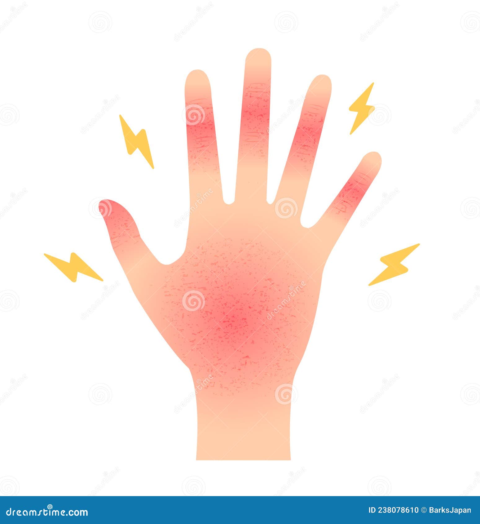 Dry and Rough Hands Chapped Hands Vector Illustration Stock Vector ...
