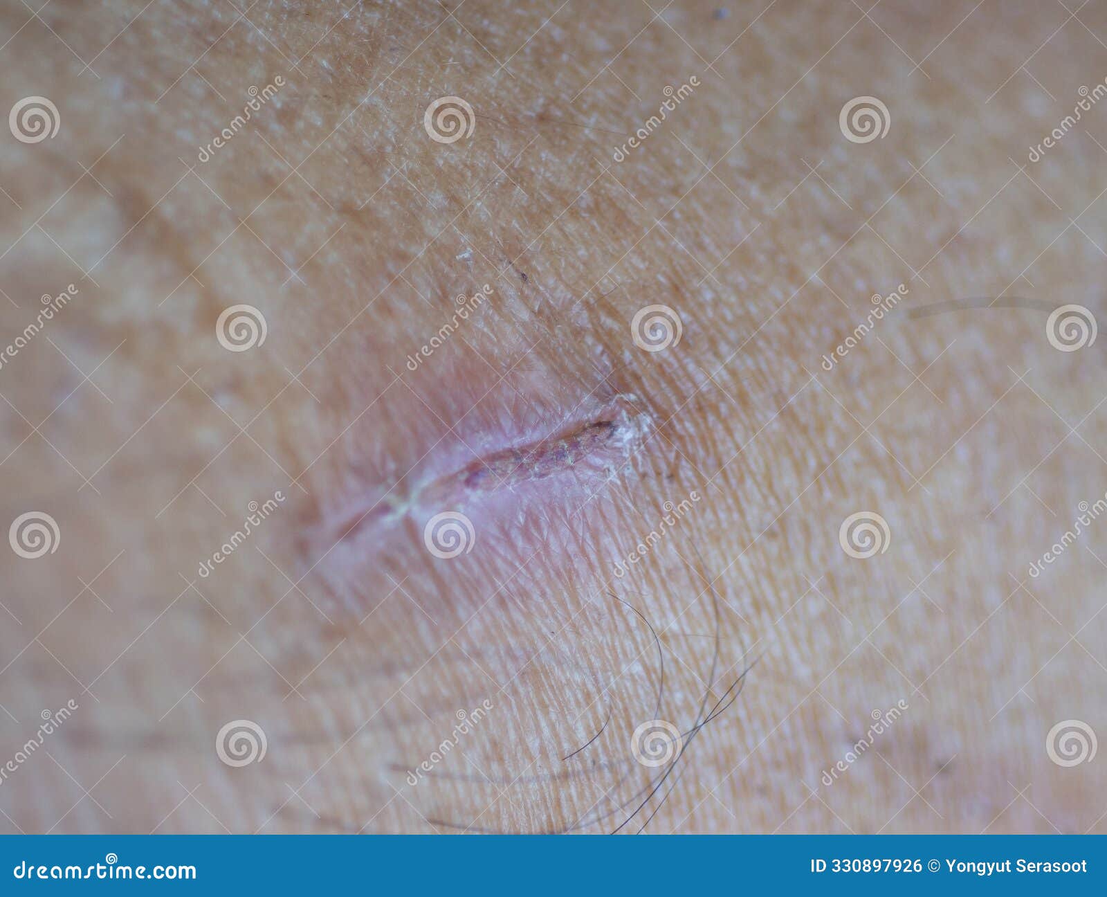 Dry scars on the skin stock photo. Image of rude, pucker - 330897926