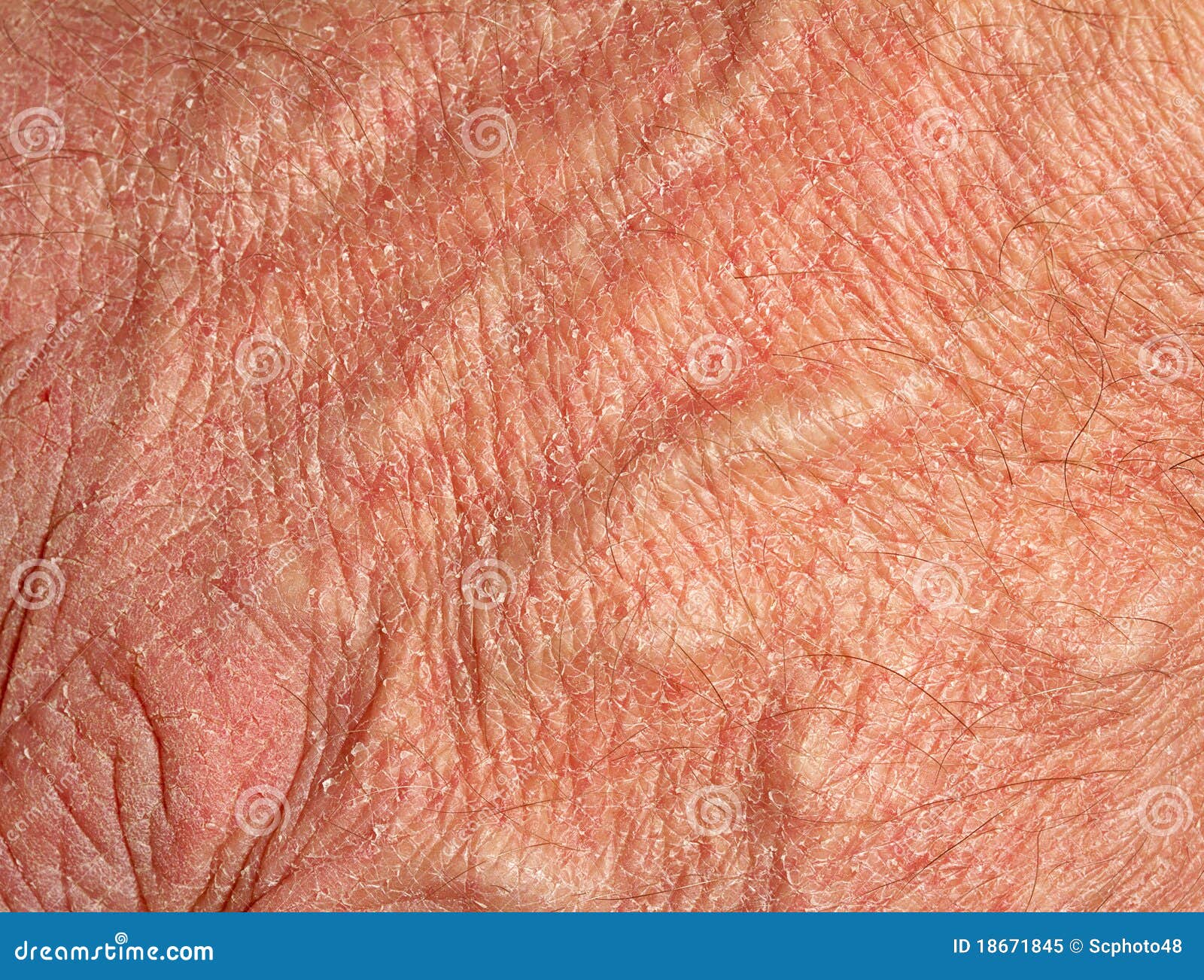 Dry skin on hand stock image. Image of detail, macro - 18671845