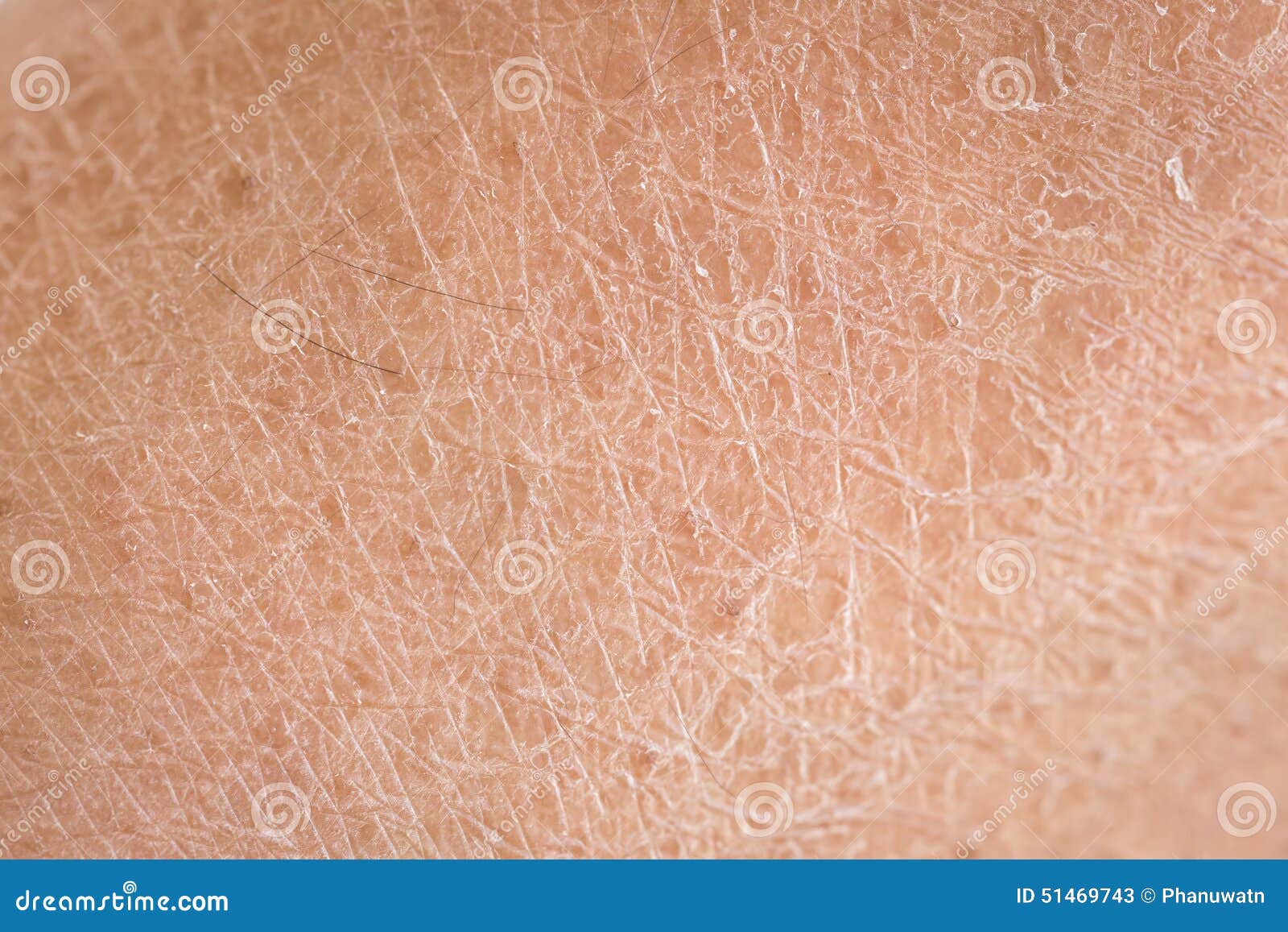 Dry Skin (ichthyosis) Detail Stock Image - Image of human, macro: 51469743