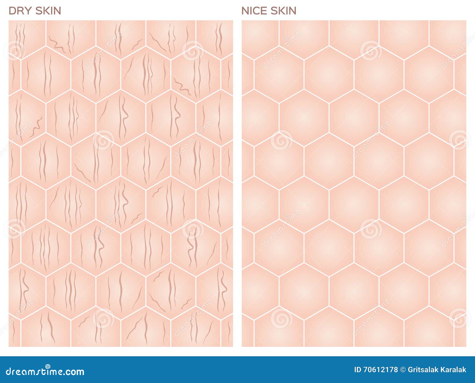 Dry Skin, Nice Skin Texture , Stock Illustration - Illustration of skin ...