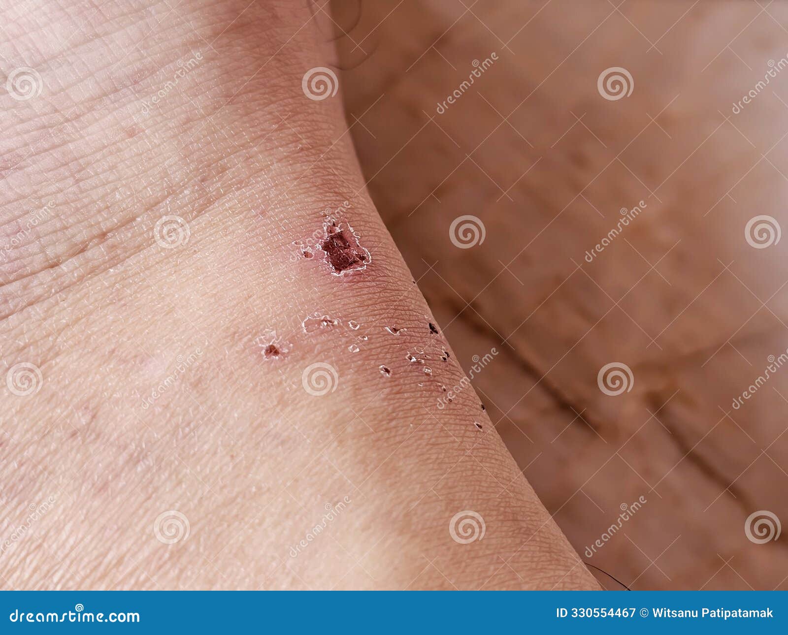 Dry Wound Caused by Itching of the Skin Stock Image - Image of care ...