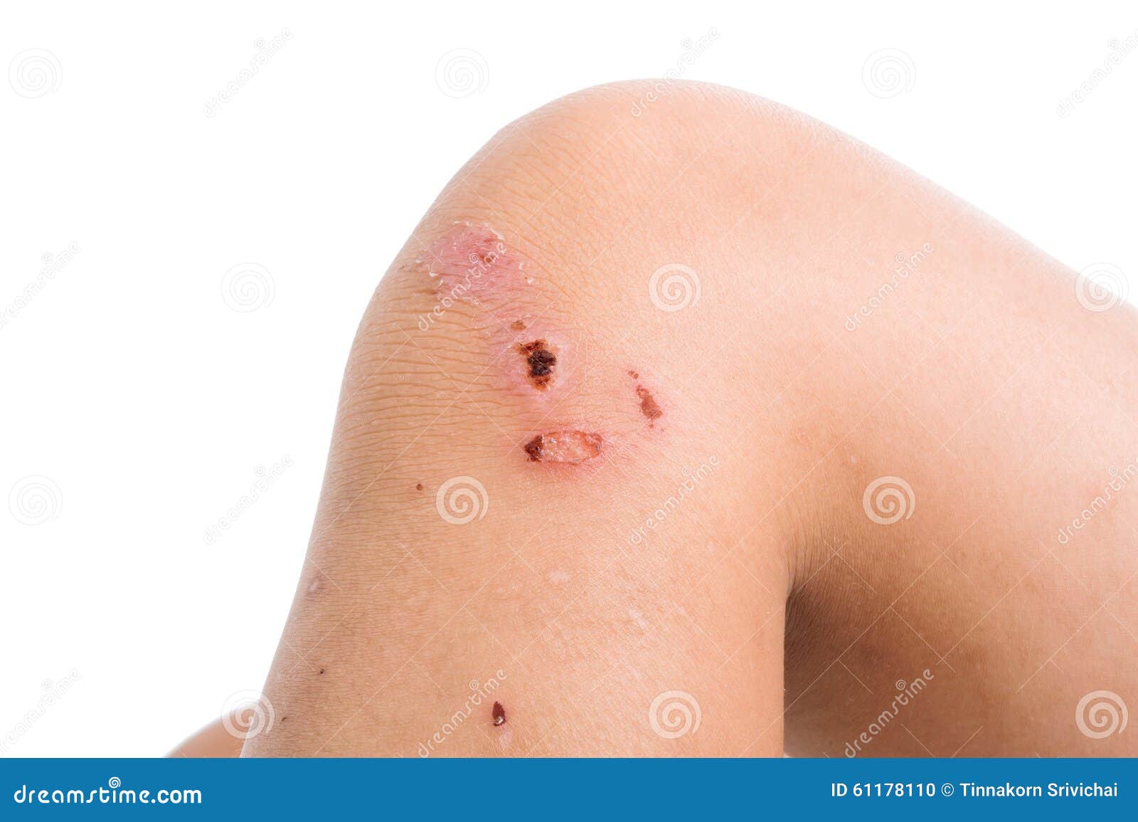 Dry Wound on Young Boy Knee Stock Photo - Image of pain, scar: 61178110