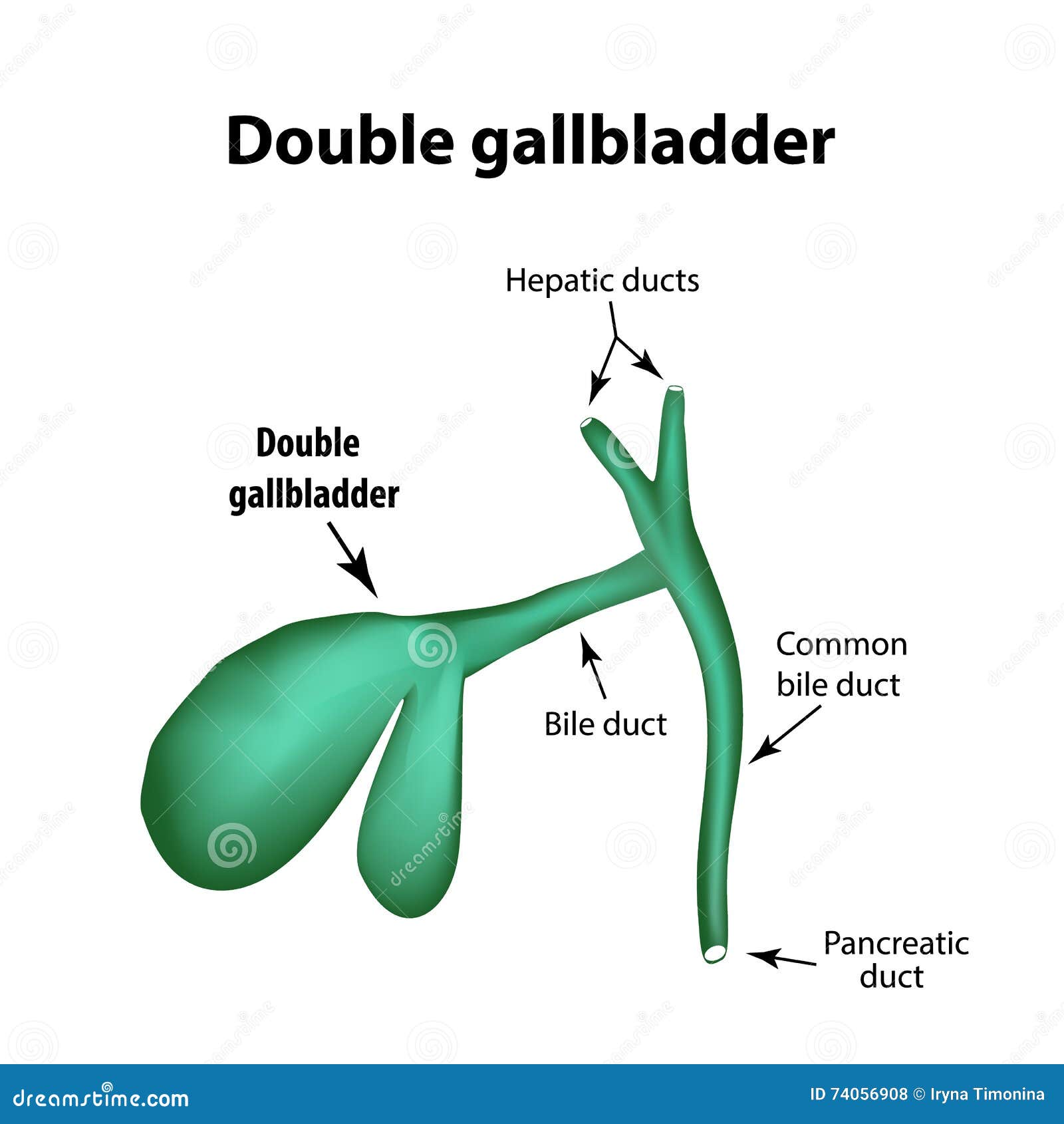 Dubbele Galblaas Pathologie Van Gallbladder Cholecystitis Vector ...