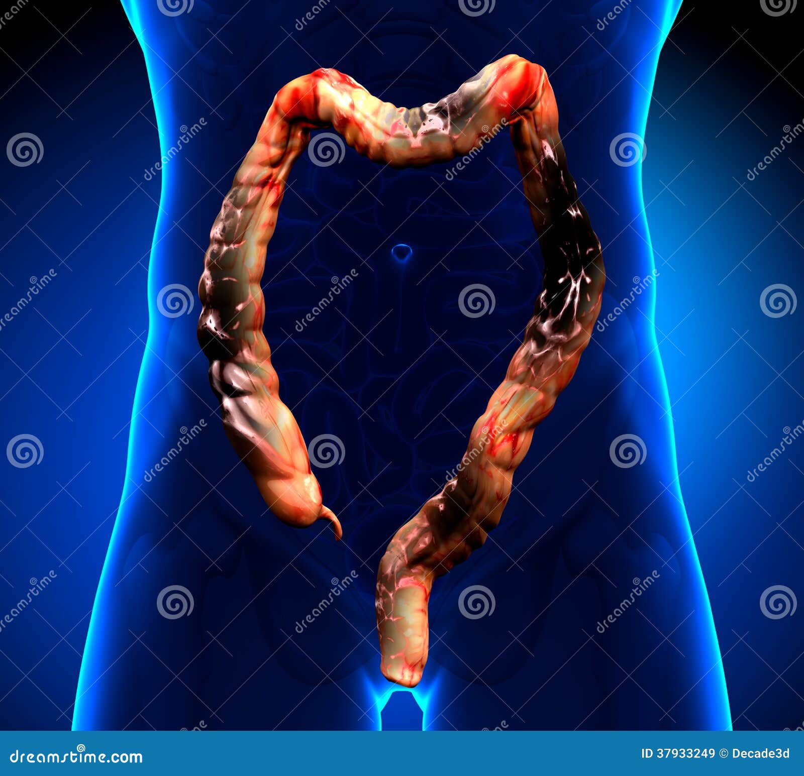 Dubbelpuntkanker/Colorectal Kanker Stock Illustratie - Illustration of ...