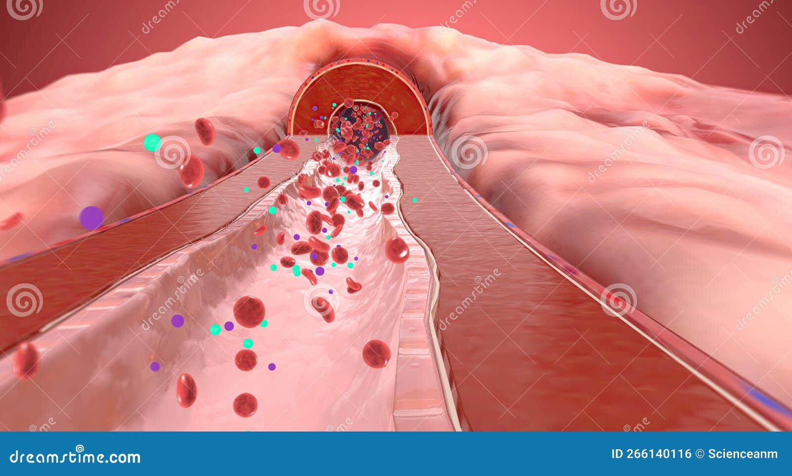 Due To Increase of Sodium and Aldosterone in the Blood Artery Constrict ...