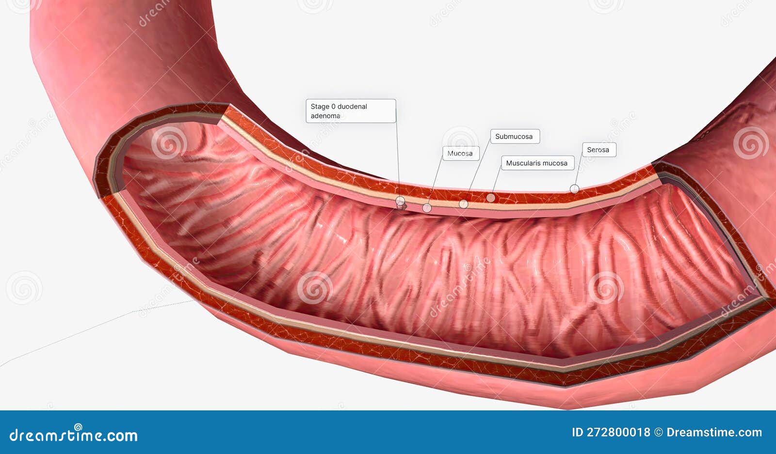 The Duodenal Carcinoma, Stage 0 3d Stock Illustration - Illustration of ...