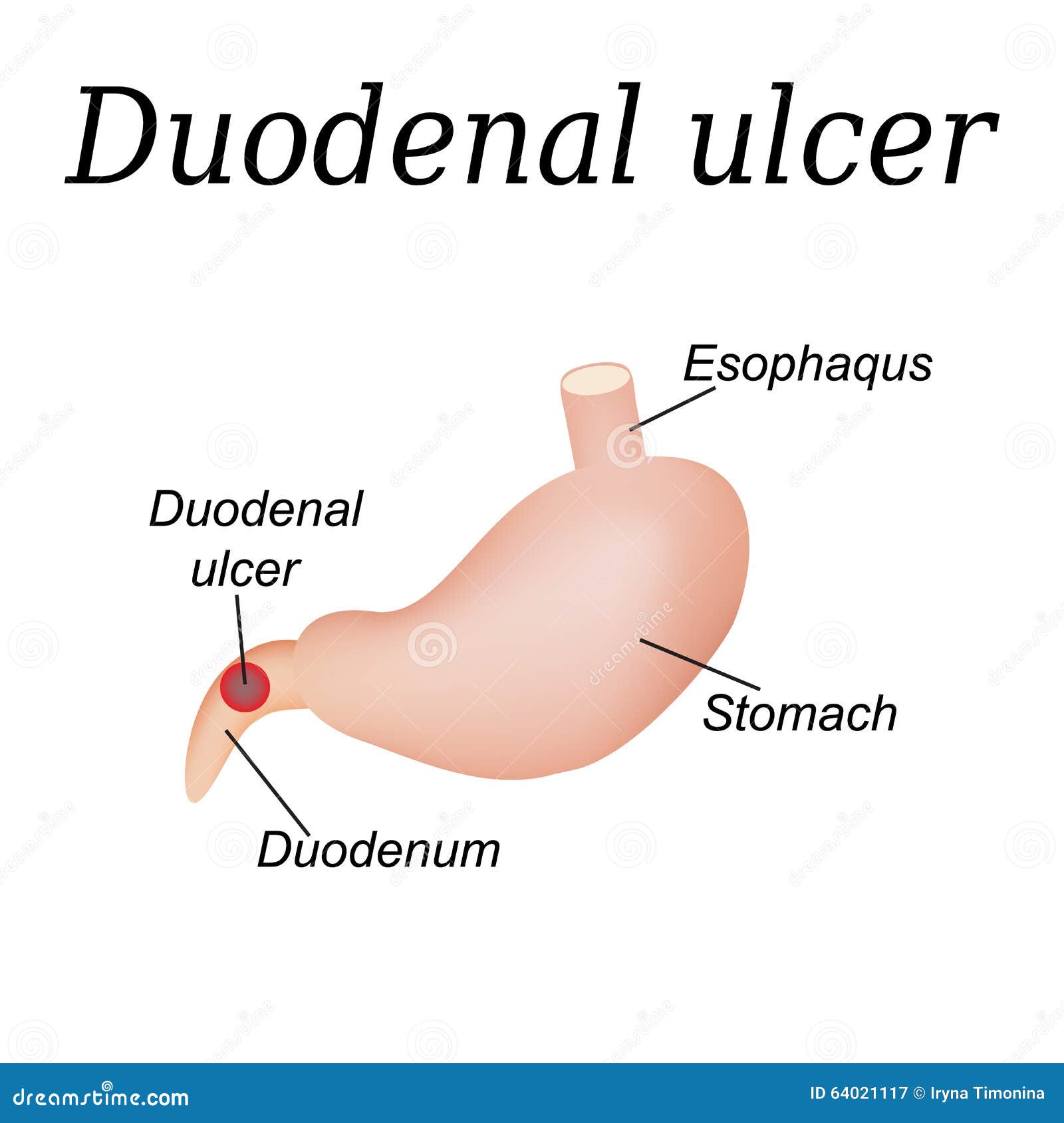 Duodenum Ulcer Affected. Duodenal Ulcer Stock Vector - Illustration of ... Duodenum Ulcer Affected. Duodenal Ulcer Stock Vector - Illustration of ...