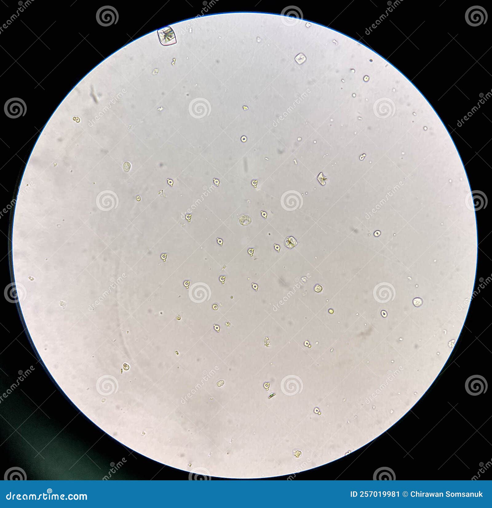 Dysmorphic Red Blood Cells In Urine Sediment Royalty-Free Stock Photo ...