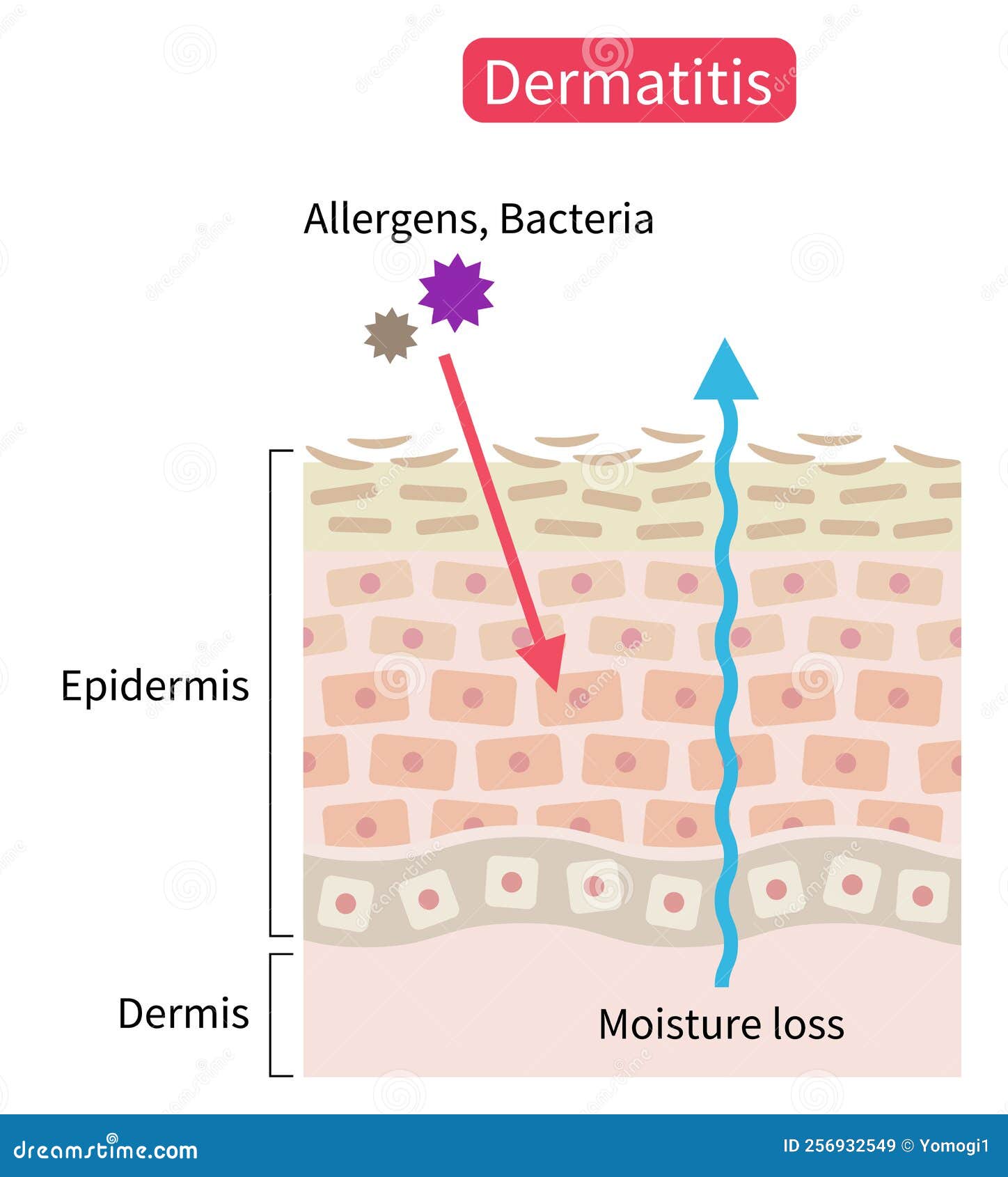 Atopic Dermatitis Eczema Dry Skin Disrupt Moisture Barrier that Allows ...
