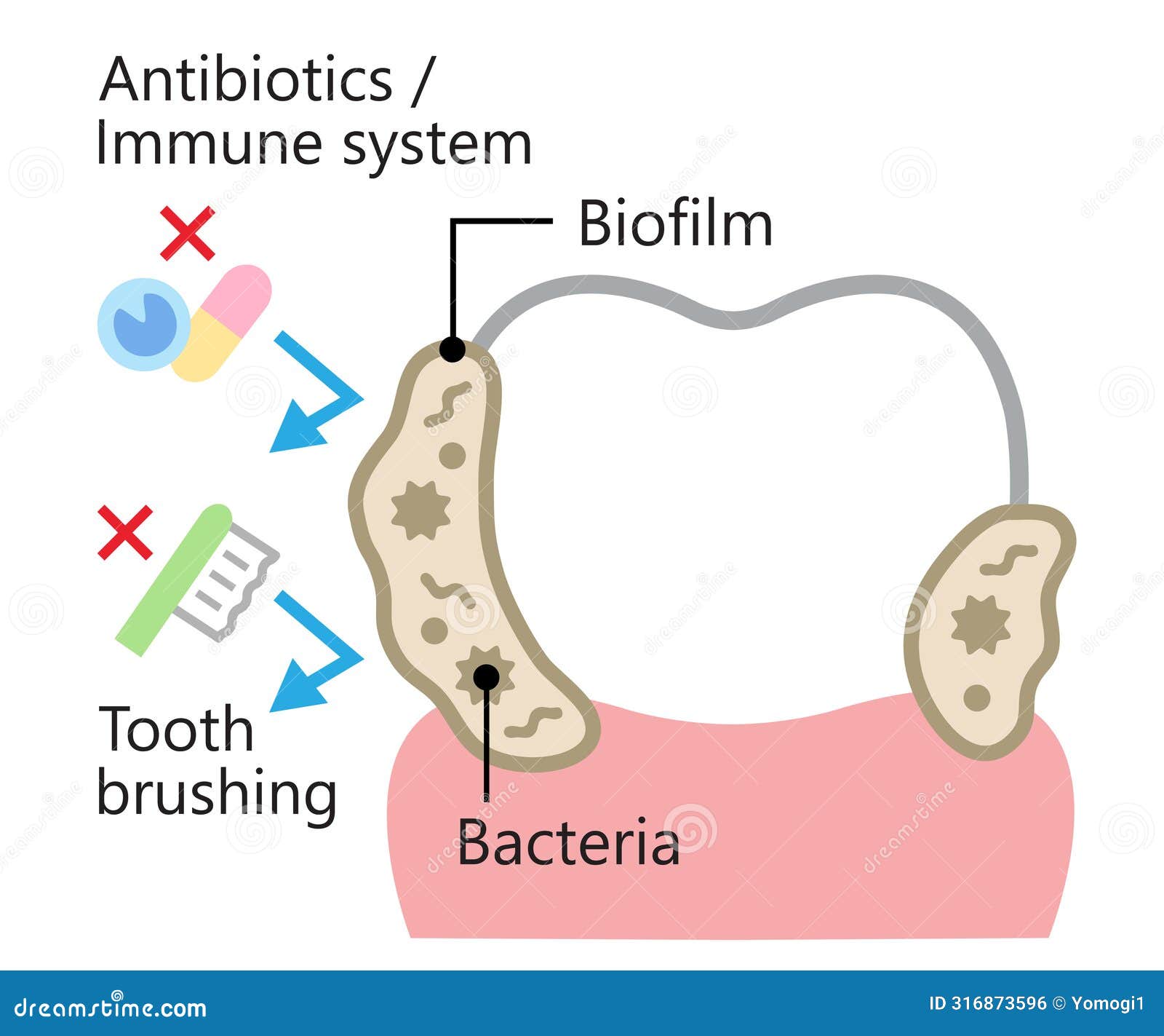 Dental Biofilm Illustration. Bacteria And Plaque Attachment On Tooth ...