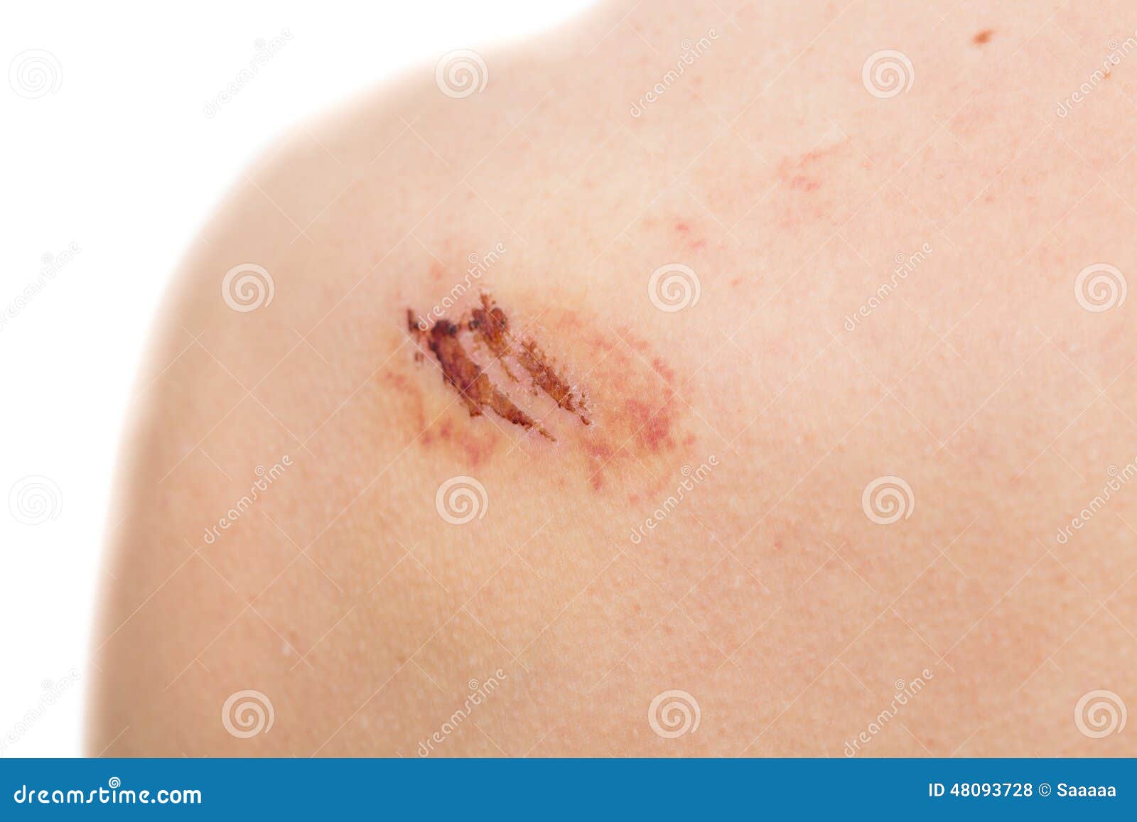 Closeup View of Scratch Over Left Shoulder 库存照片 - 图片 包括有 斑点病, 头发: 48093728