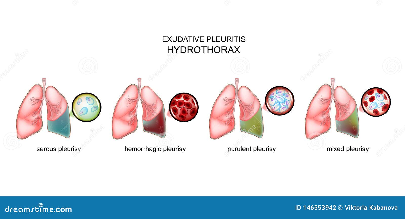 Types of Exudative Pleurisy and Hydrothorax Vektor Illustrationer ...