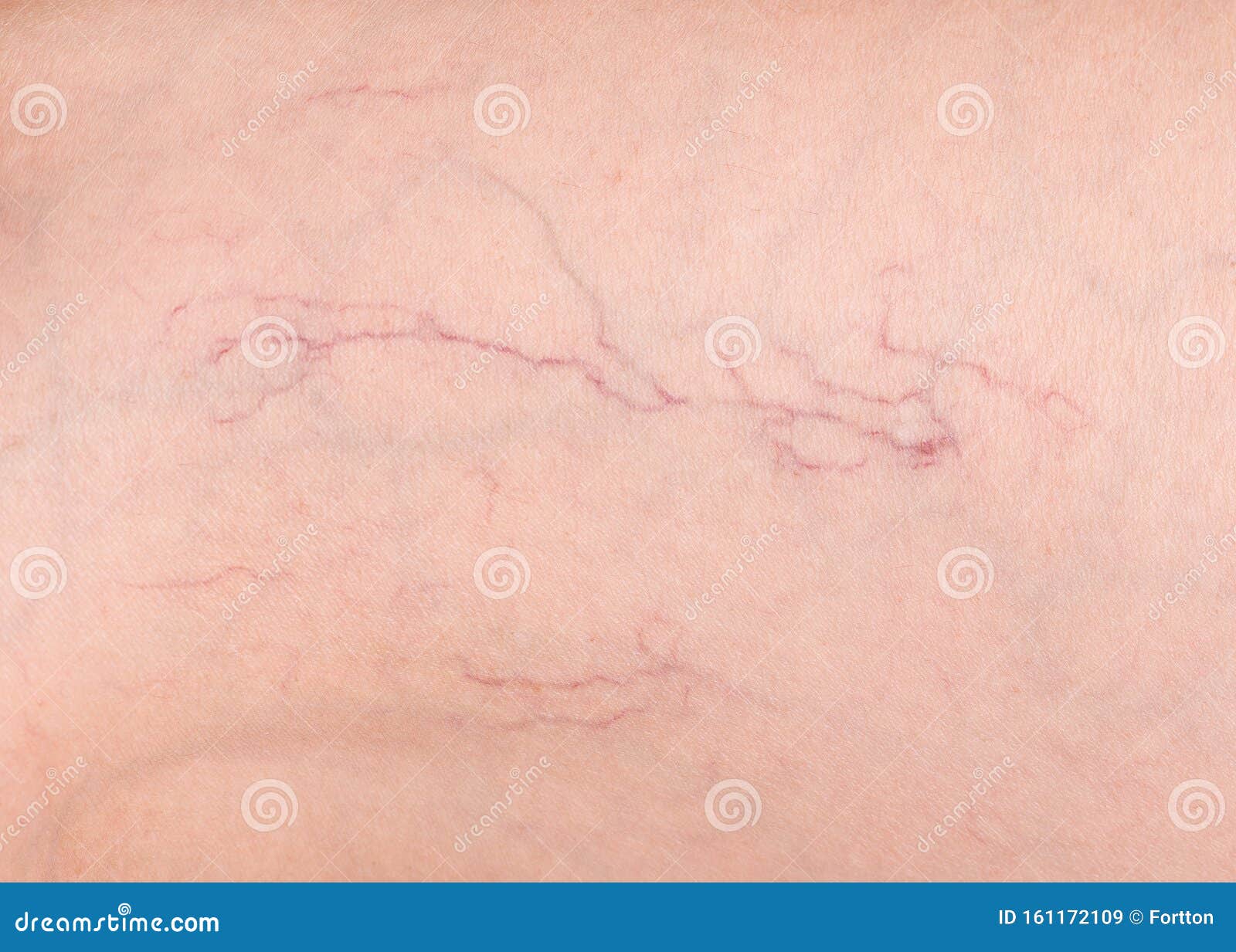 A Fragment of Human Skin with Varicose Veins 库存图片 - 图片 包括有 真皮, 医疗 ...
