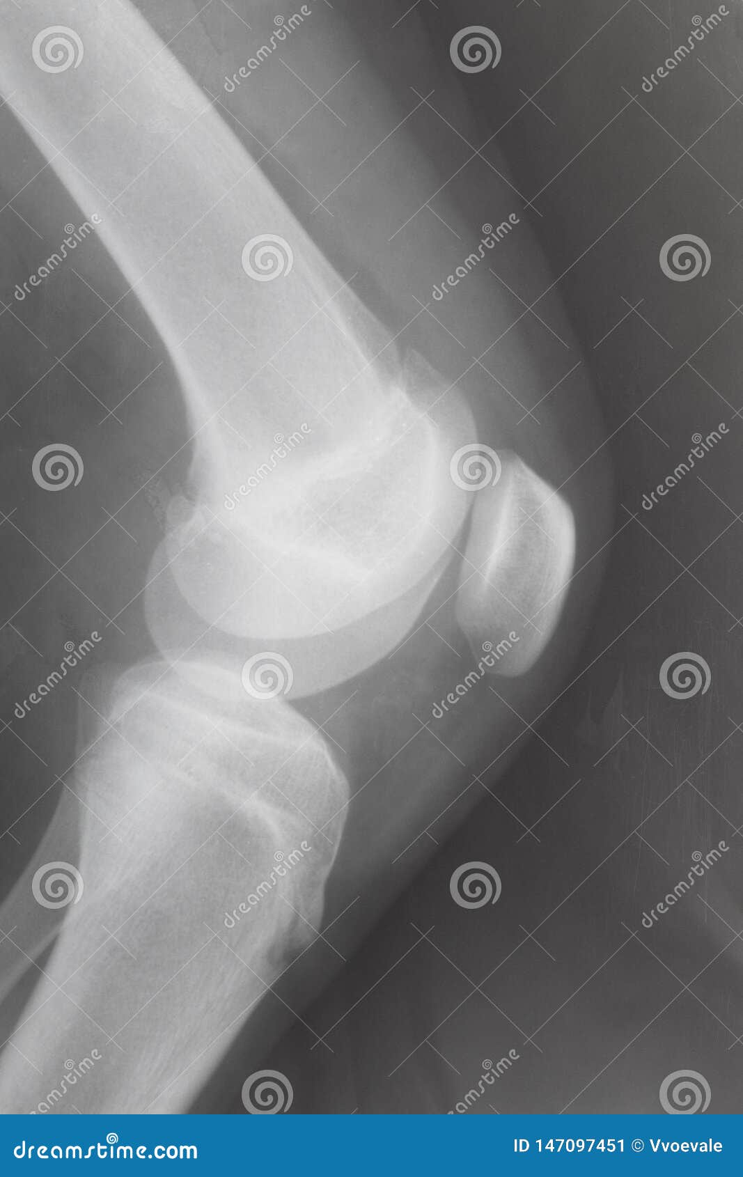 Human Knee-joint with Kneecap on X-ray Image Stock Image - Image of ...