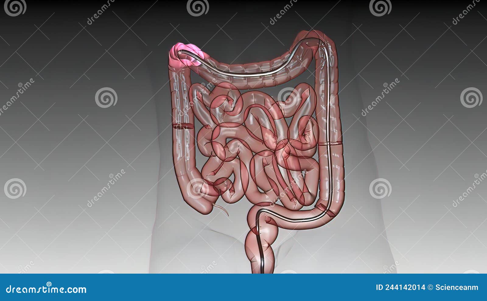 Eamination of the Large Intestine Under Amonitor with a Fiberoptic ...