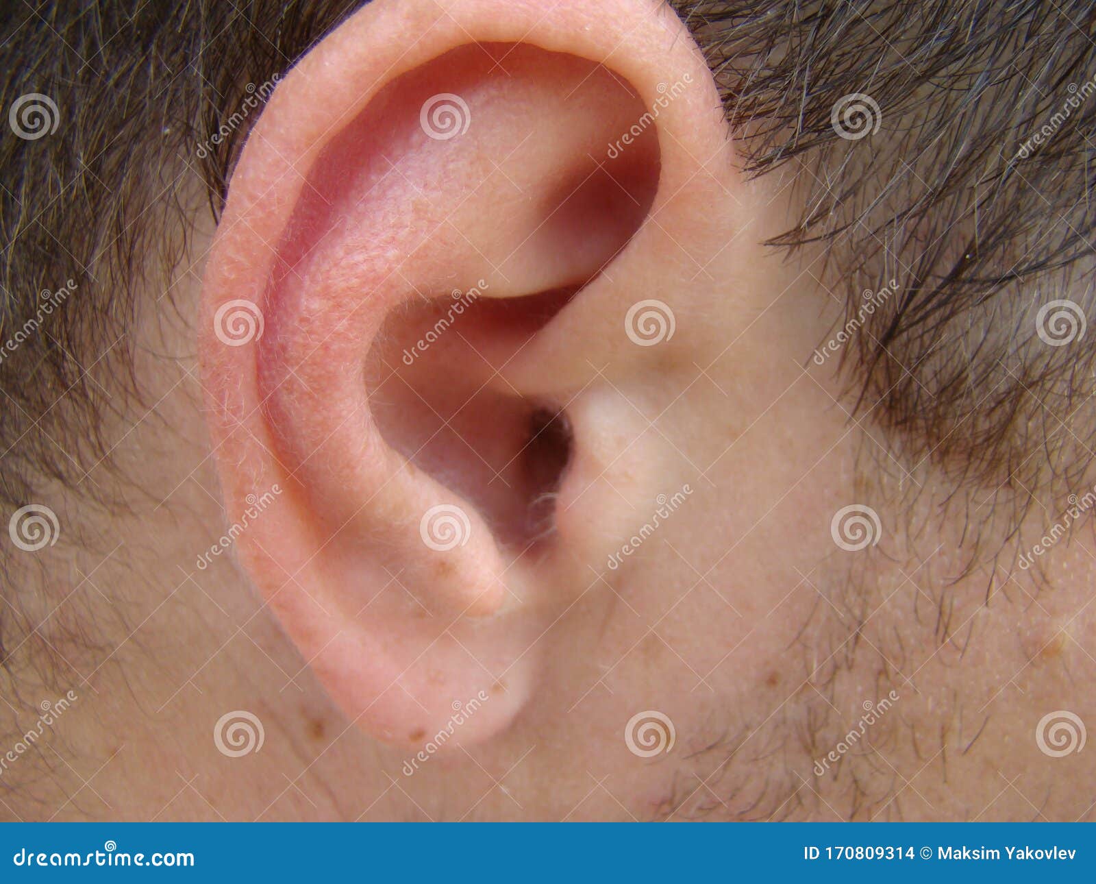 Darwin`s Tubercle On The Ear. The Girl At The Reception At The Plastic ...