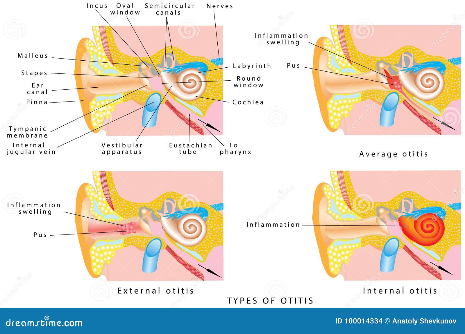 Otitis Cartoons, Illustrations & Vector Stock Images - 1156 Pictures to ...