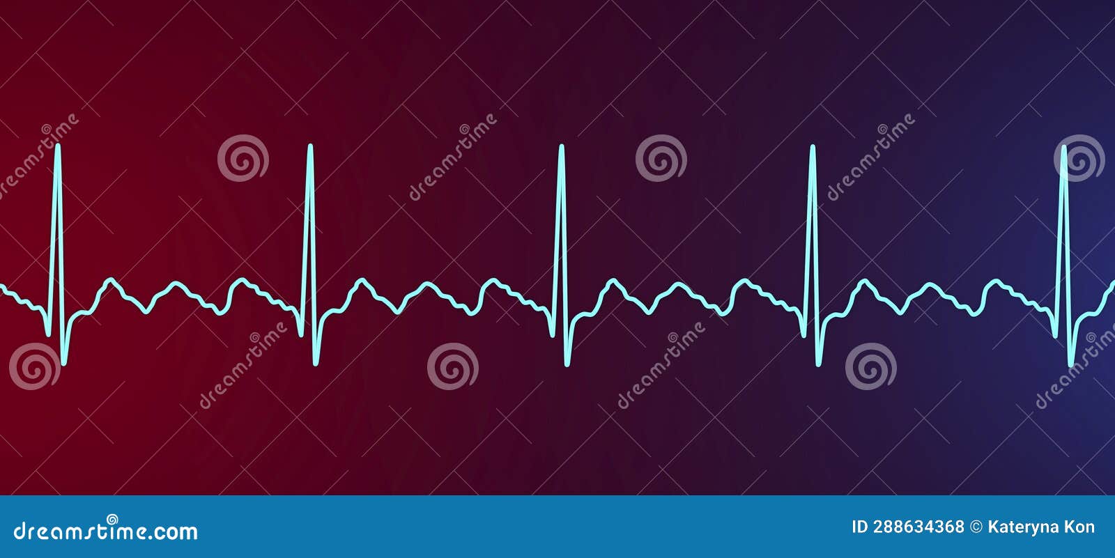 ECG In Atrial Flutter, An Abnormal Heart Rhythm Characterized By Rapid ...