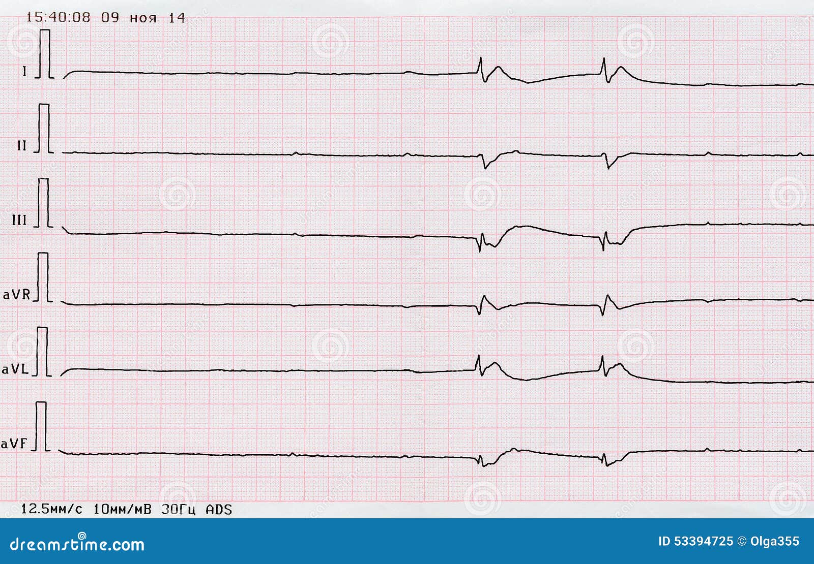 ECG-band (het Sterven Hart) Stock Afbeelding - Image of uitprinten ...