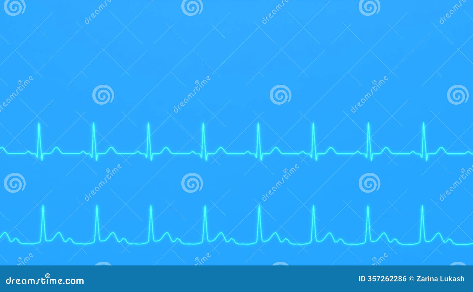 Normal Heart Rhythm ECG And Ventricular Fibrillation Stock Image ...