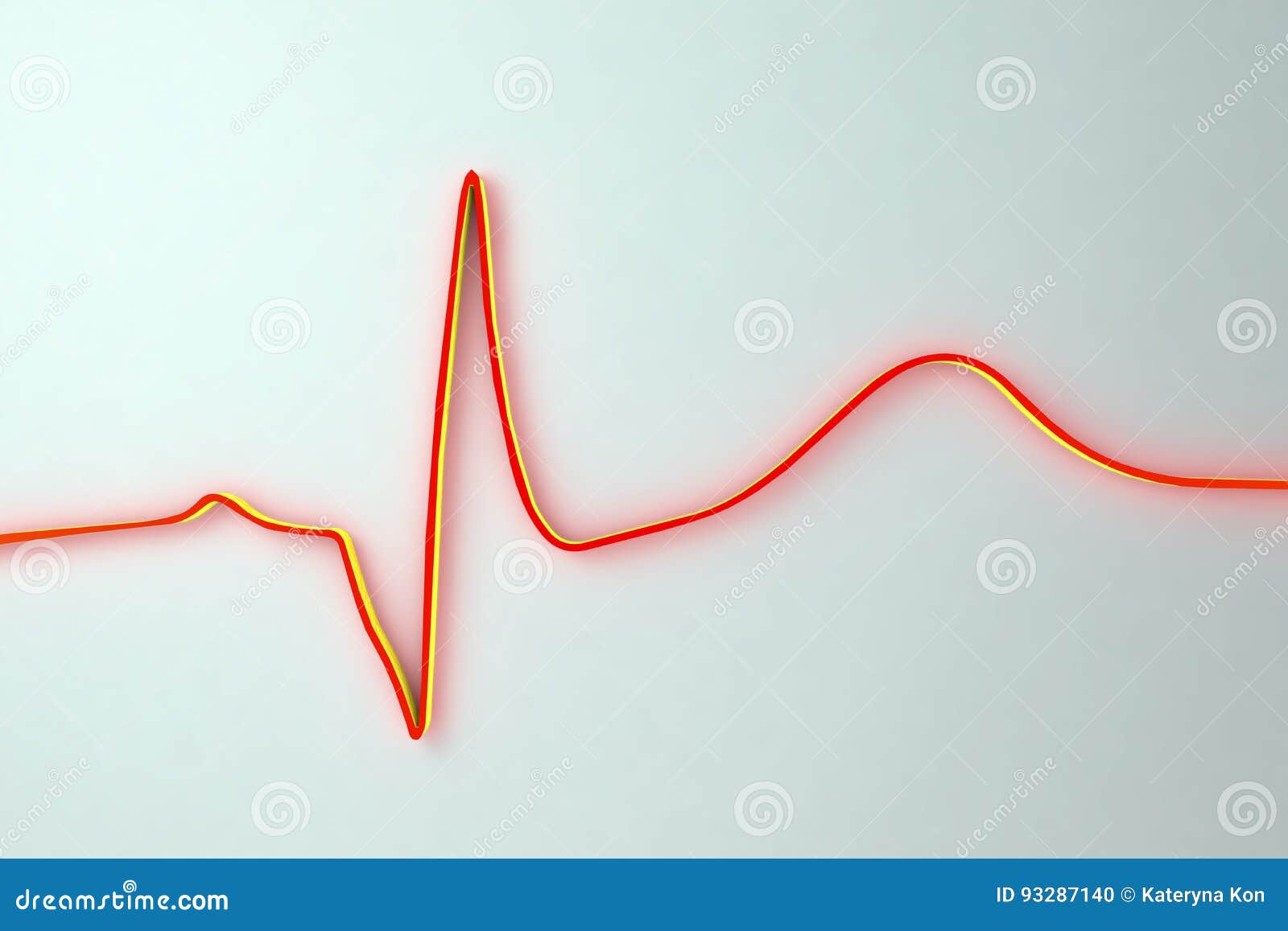 ECG Dans L'infarctus Du Myocarde Illustration Stock - Illustration du ...