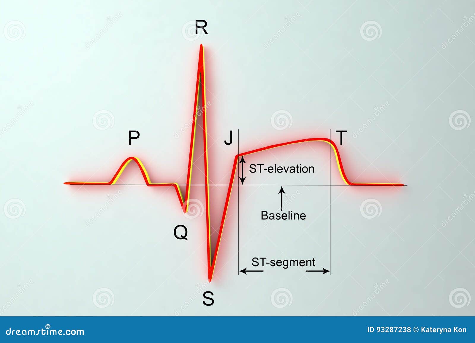 ECG Dans L'infarctus Du Myocarde E Illustration Stock - Illustration du ...