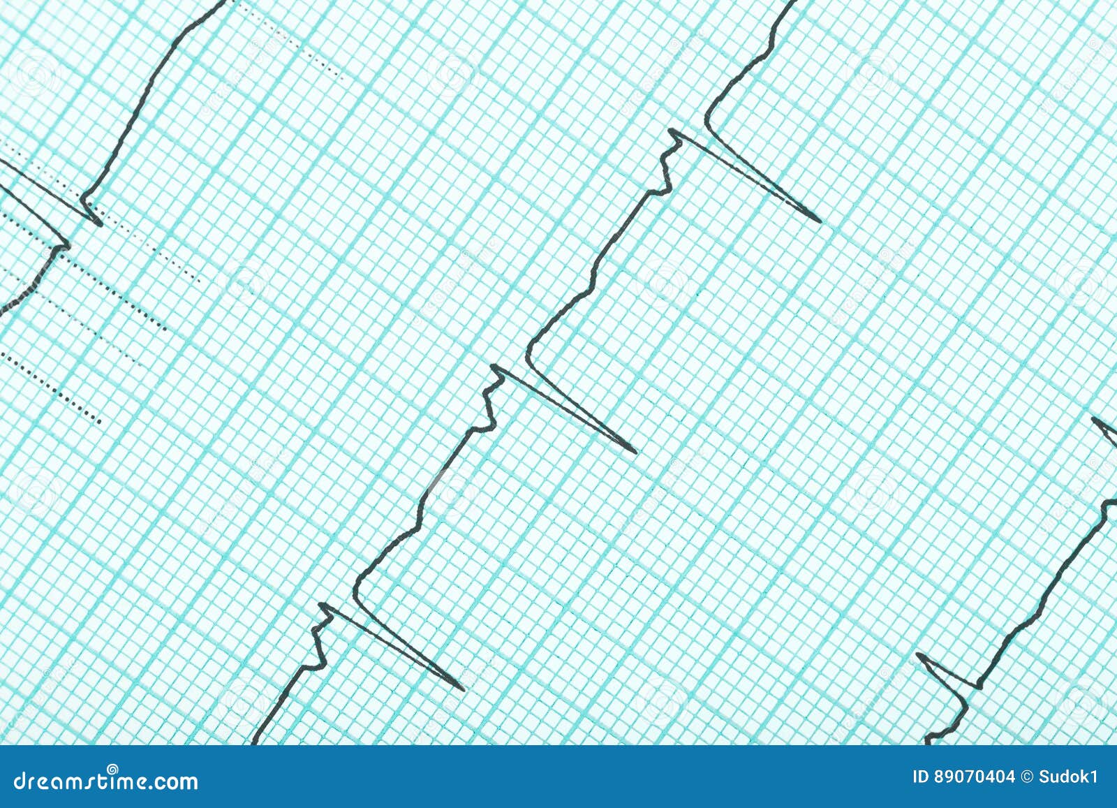 ECG Diagnostics As a Medical Background Stock Photo - Image of ...