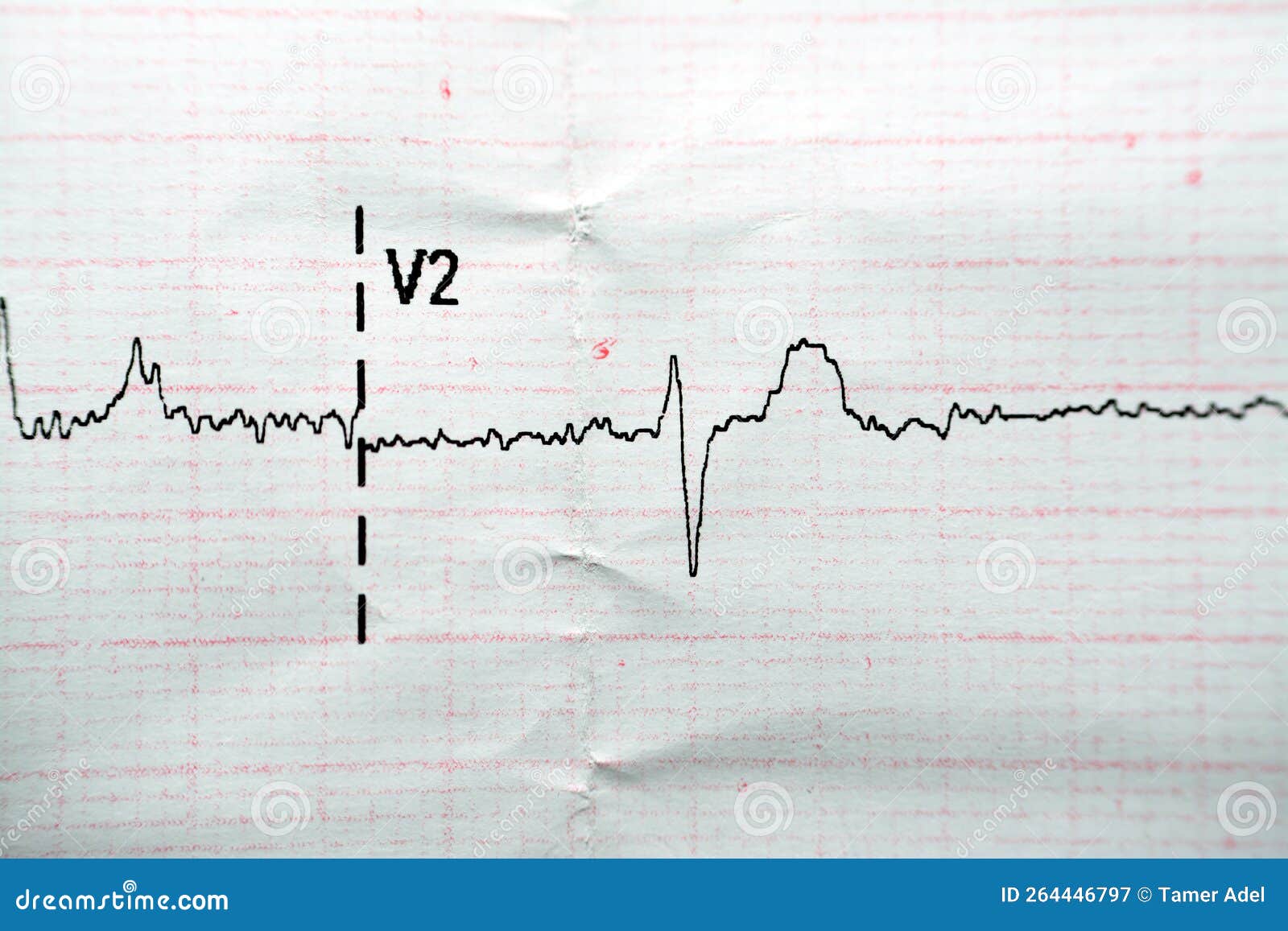 Ecg Electrocardiograph Paper That Shows Normal Sinus Rhythm Nsr With Frequent Pacs Premature