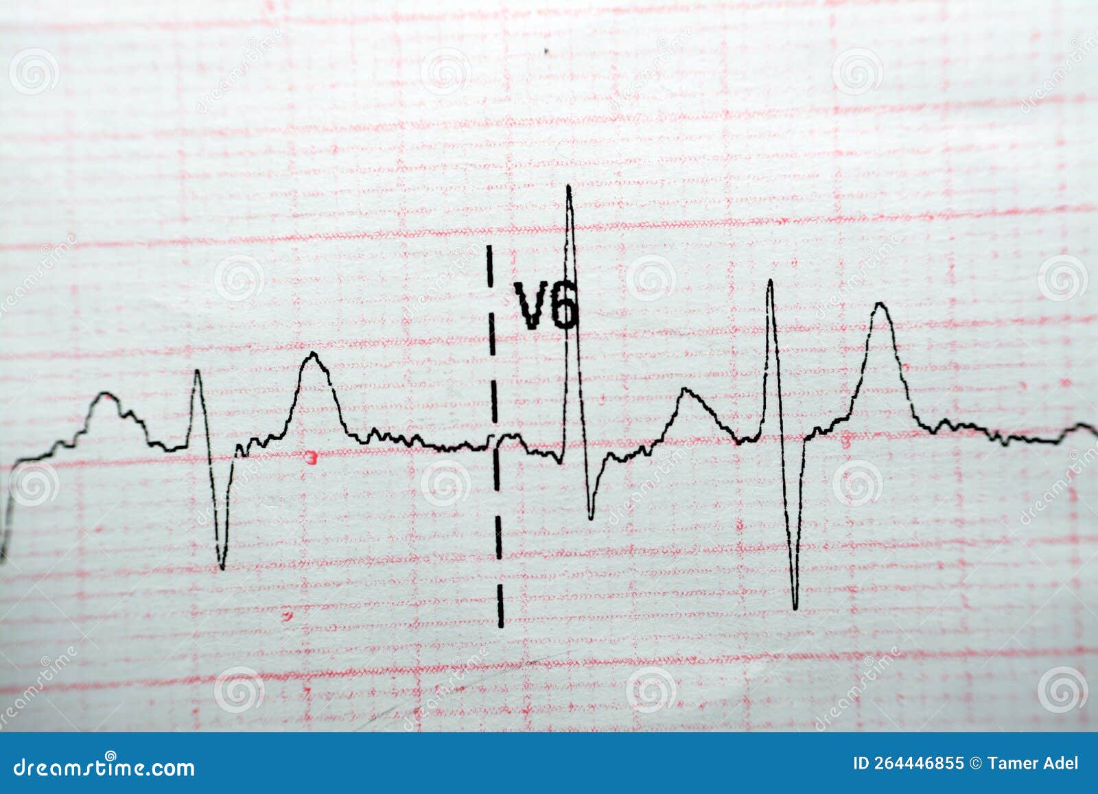 Ecg Electrocardiograph Paper That Shows Normal Sinus Rhythm Nsr With Frequent Pacs Premature