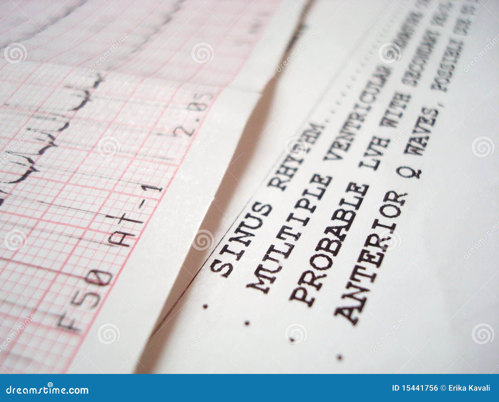 ECG Electrocardiography Diagram Stock Photo - Image of paper ...
