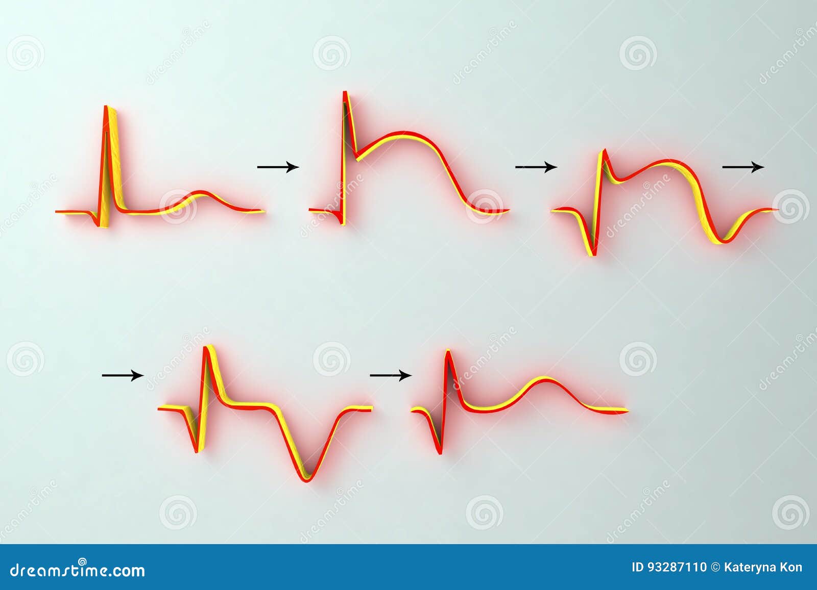 ECG in Myocardial Infarction, Illustration Showing Evolution of ECG ...
