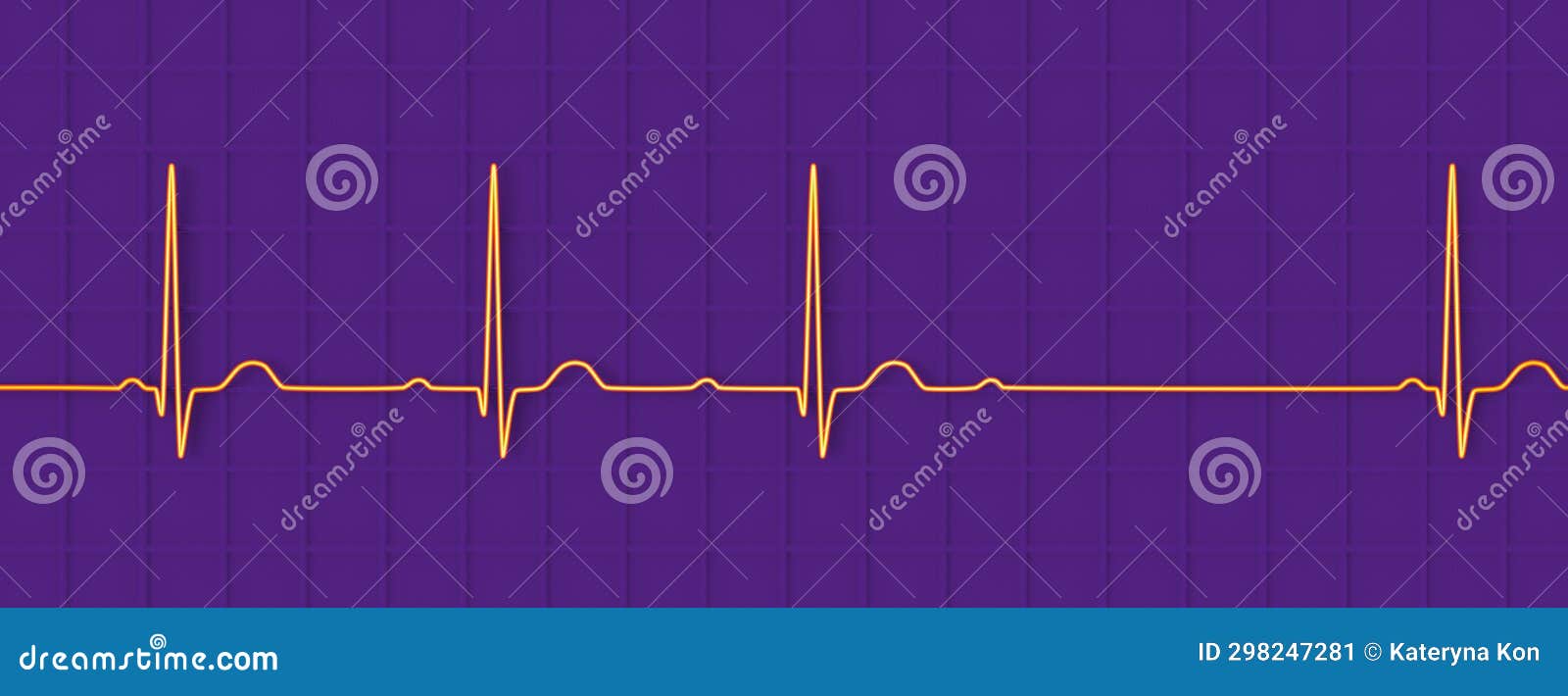 ECG Of 1st Degree AV Block, 3D Illustration Royalty-Free Cartoon ...